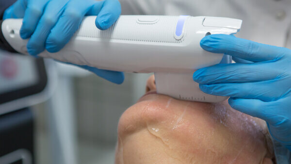 IPL for scars: Enhancing Acne, Surgical and Stretch marks