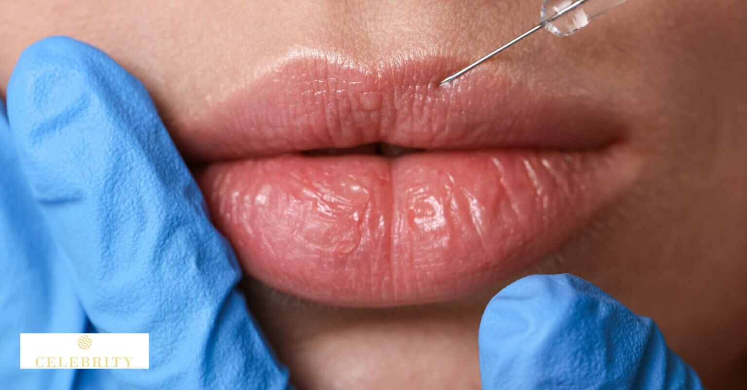 Lip Flip vs. Lip Fillers: Which Is Right for You?